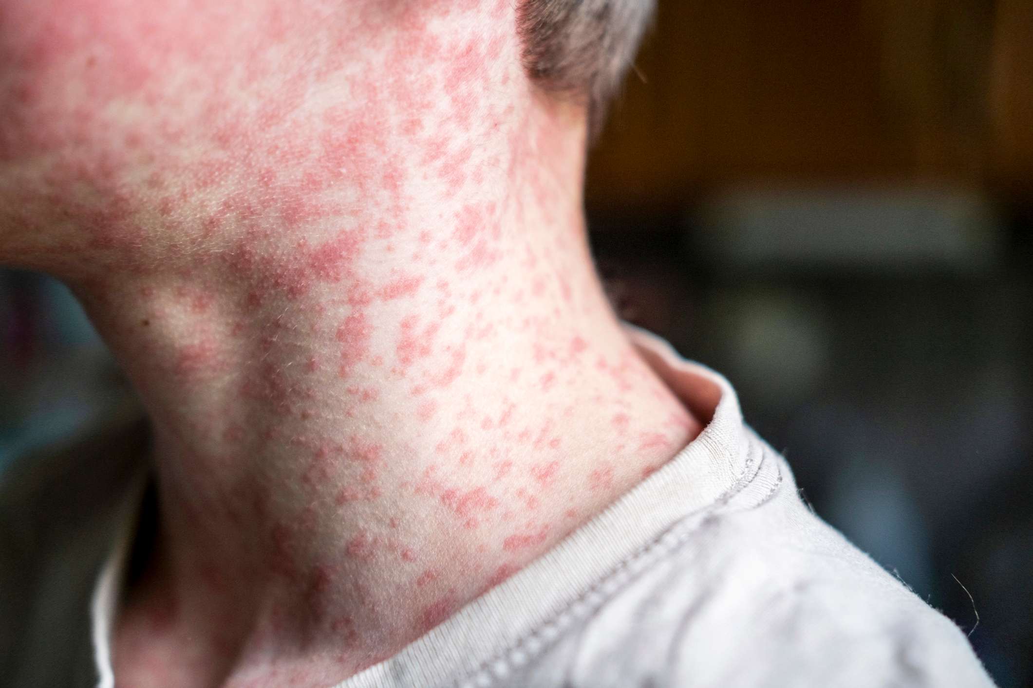 UPDATE: Health Unit announces eight more measles exposure points
